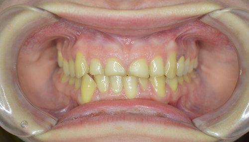 What You Need To Know About Toothwear - Claire Hughes Dental | Dentist ...